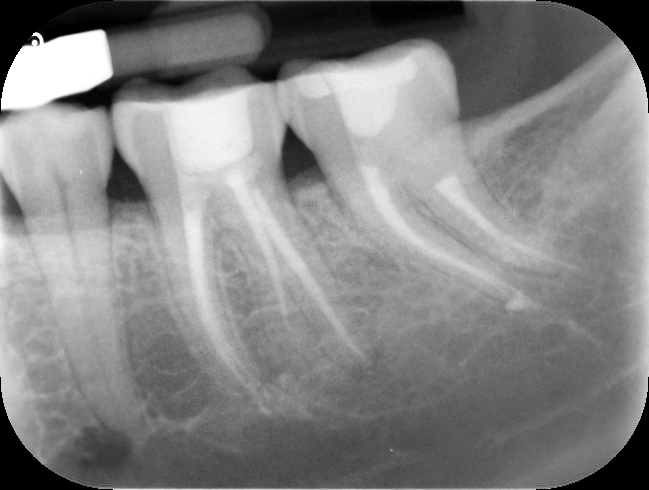 EXTERNAL TRANSPORTATION/PERFORATION AND ITS MANAGEMENT IN A PATIENT ...
